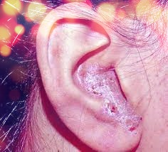 comprendre et traiter l'eczéma d'oreille
